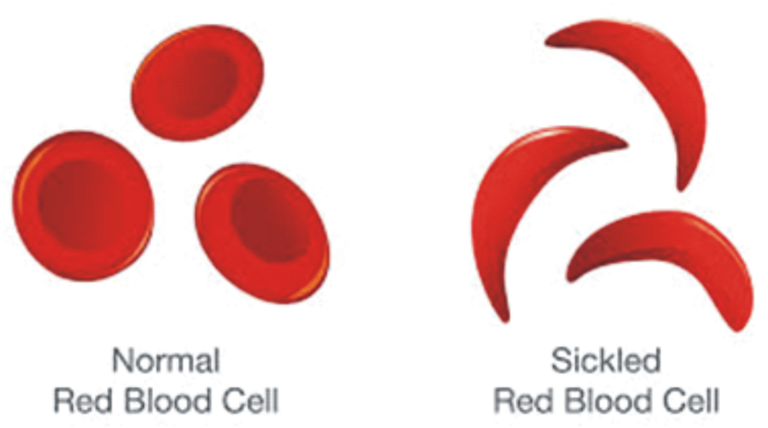Top 10 Facts About Sickle Cell Disease You Need To Know ...